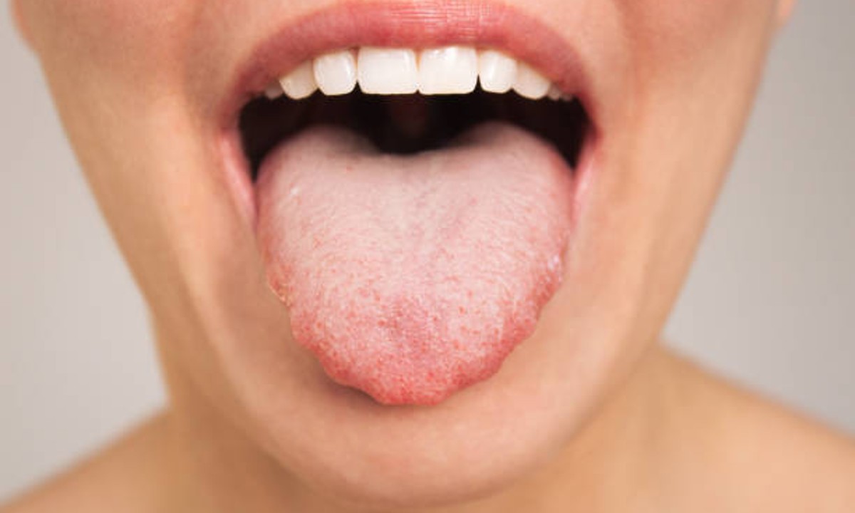 ¿Detectar enfermedades solo viendo color de la lengua? IA logra nivel ...