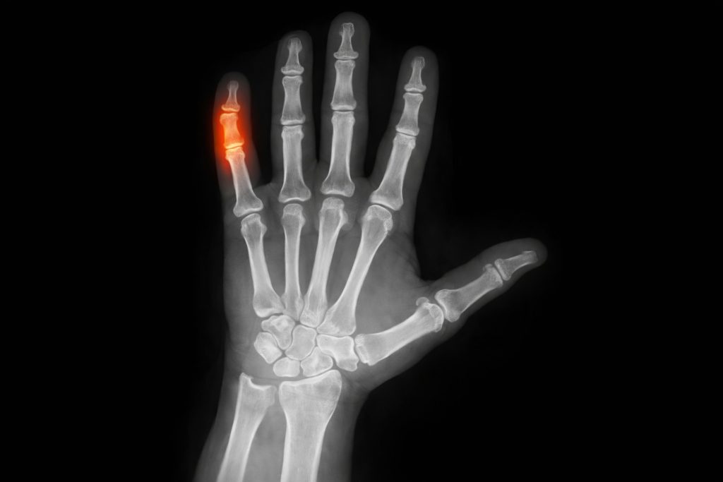 Texting pinky: qué es y cómo prevenirlo al usar el celular